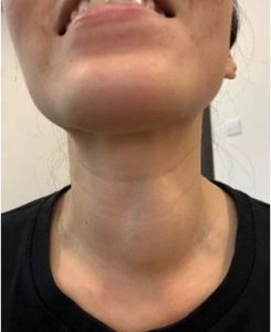 Multinodular Goiter - Thyroid In Women